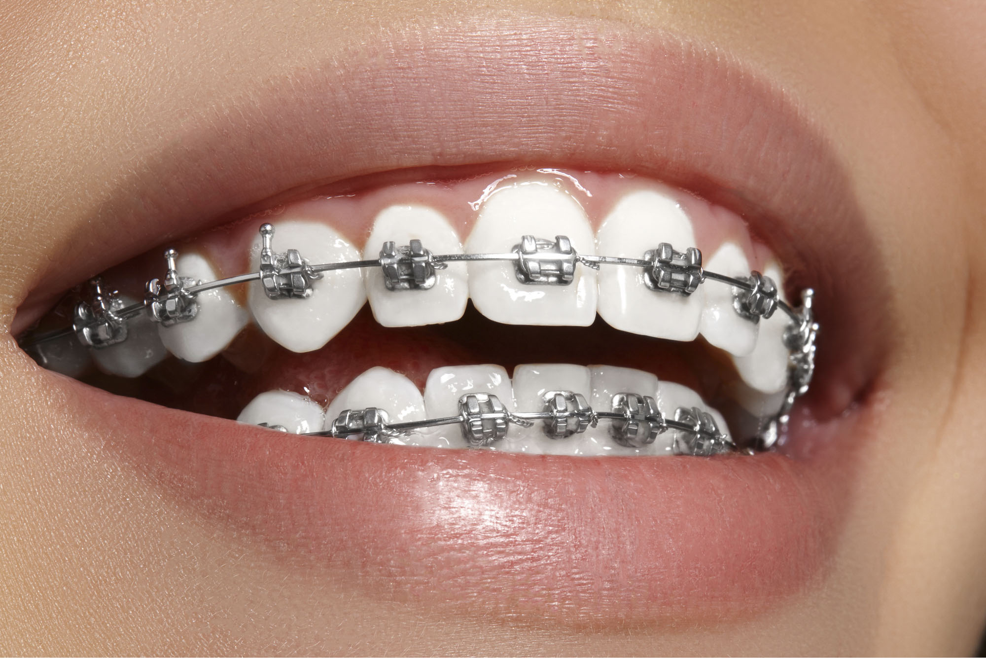Fixed Braces in Brisbane | Smile Studio Newstead