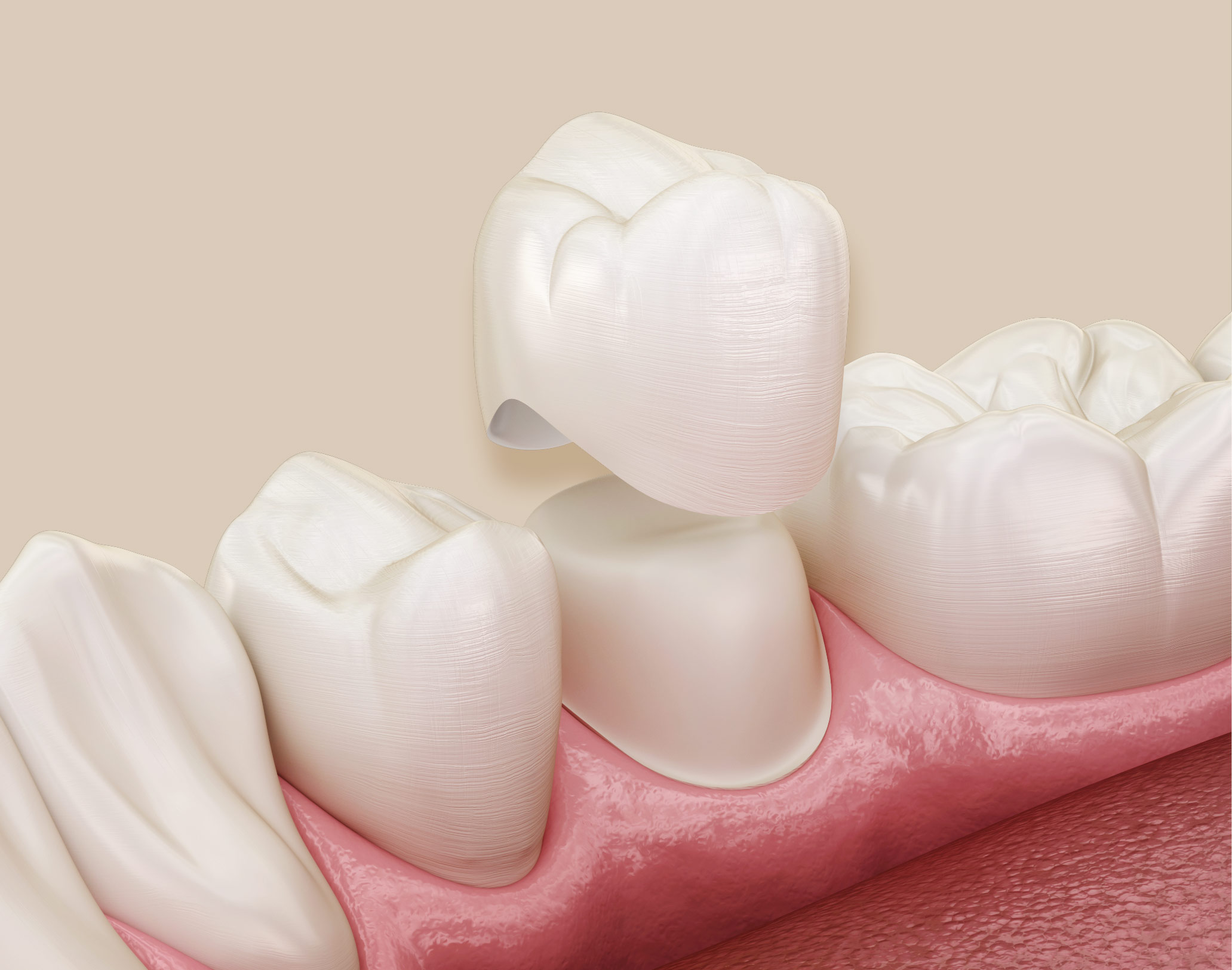 Porcelain Crowns & Bridges | Smile Studio Newstead